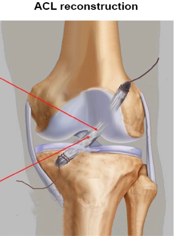 ACL Repair Surgery Mahwah Valley Orthopedic Associates ACL Repair Surgery Mahwah Valley Orthopedic Associates